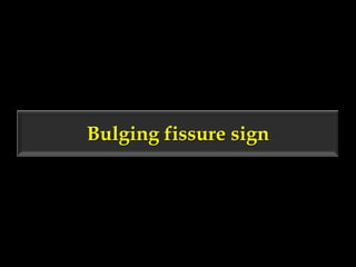 Figure 3 sign fleischner sign-fissure sign-headcheese sign-hilar ...