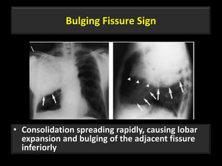 Figure 3 sign fleischner sign-fissure sign-headcheese sign-hilar ...