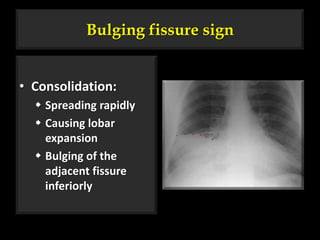 Bulging Fissure Sign
