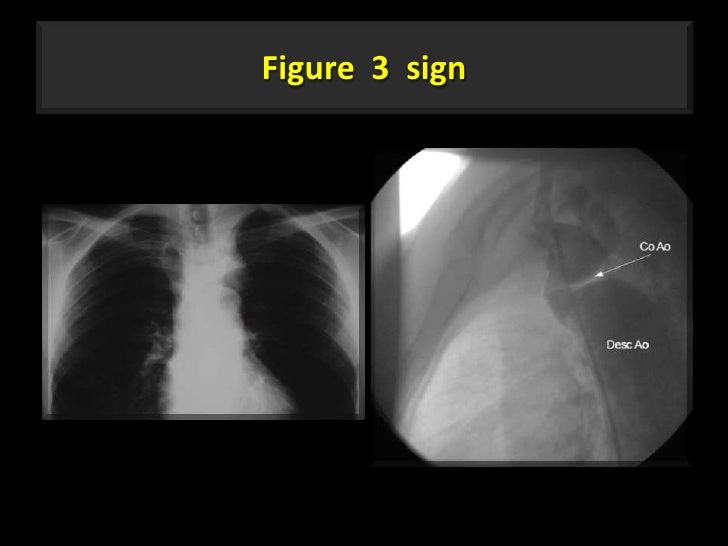 Figure 3 sign fleischner sign-fissure sign-headcheese sign-hilar over…