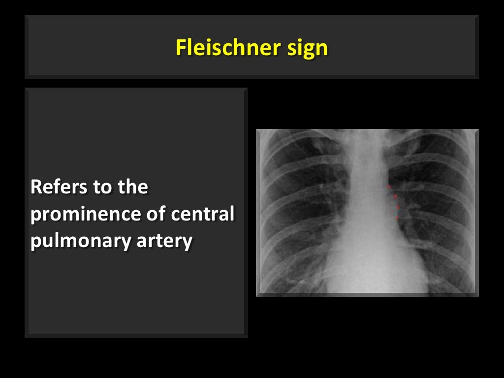 Figure 3 sign fleischner sign-fissure sign-headcheese sign-hilar over…