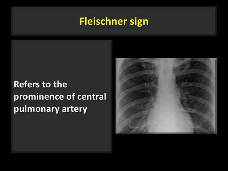 Figure 3 sign fleischner sign-fissure sign-headcheese sign-hilar over…