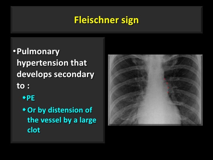 Figure 3 sign fleischner sign-fissure sign-headcheese sign-hilar over…