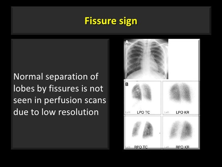 Figure 3 sign fleischner sign-fissure sign-headcheese sign-hilar over…