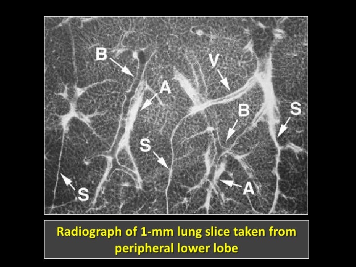 Figure 3 sign fleischner sign-fissure sign-headcheese sign-hilar over…