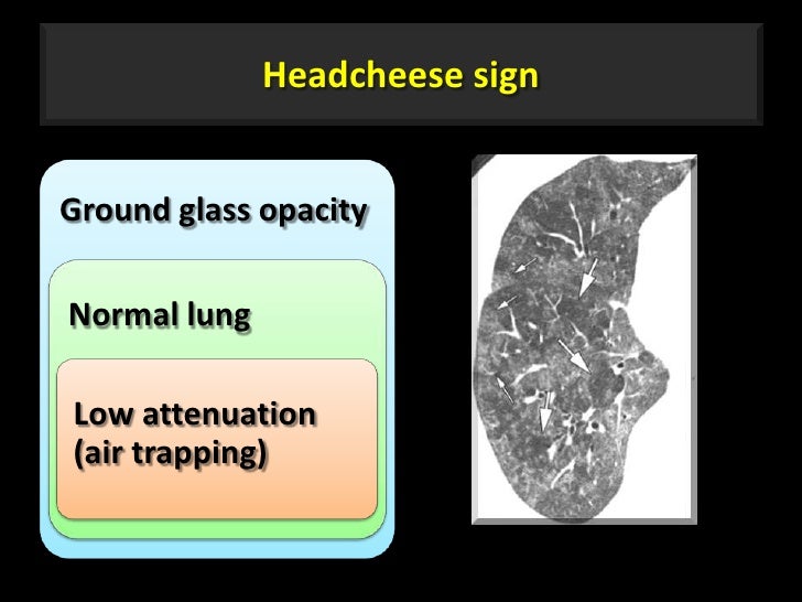 Figure 3 sign fleischner sign-fissure sign-headcheese sign-hilar over…