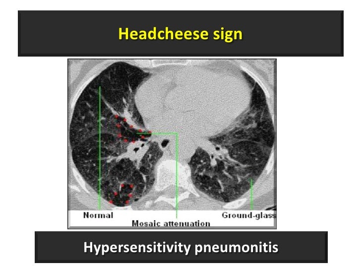 Figure 3 sign fleischner sign-fissure sign-headcheese sign-hilar over…