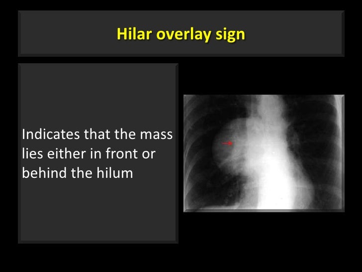 Figure 3 sign fleischner sign-fissure sign-headcheese sign-hilar over…