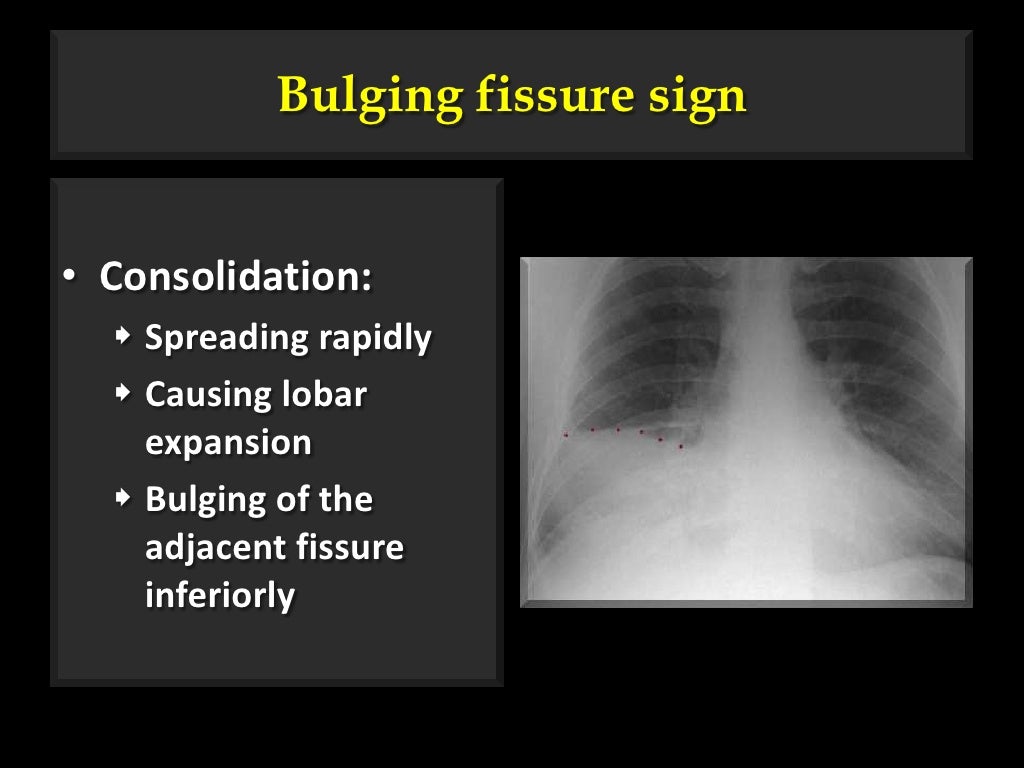 Figure 3 sign fleischner sign-fissure sign-headcheese sign-hilar over…