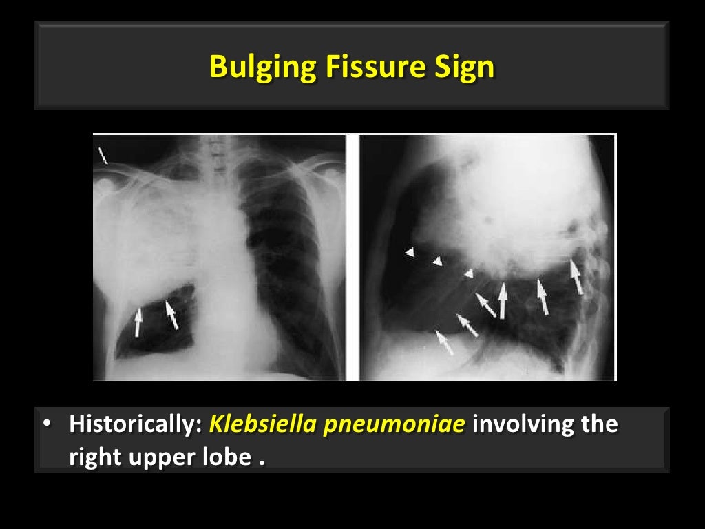 Figure 3 sign fleischner sign-fissure sign-headcheese sign-hilar over…