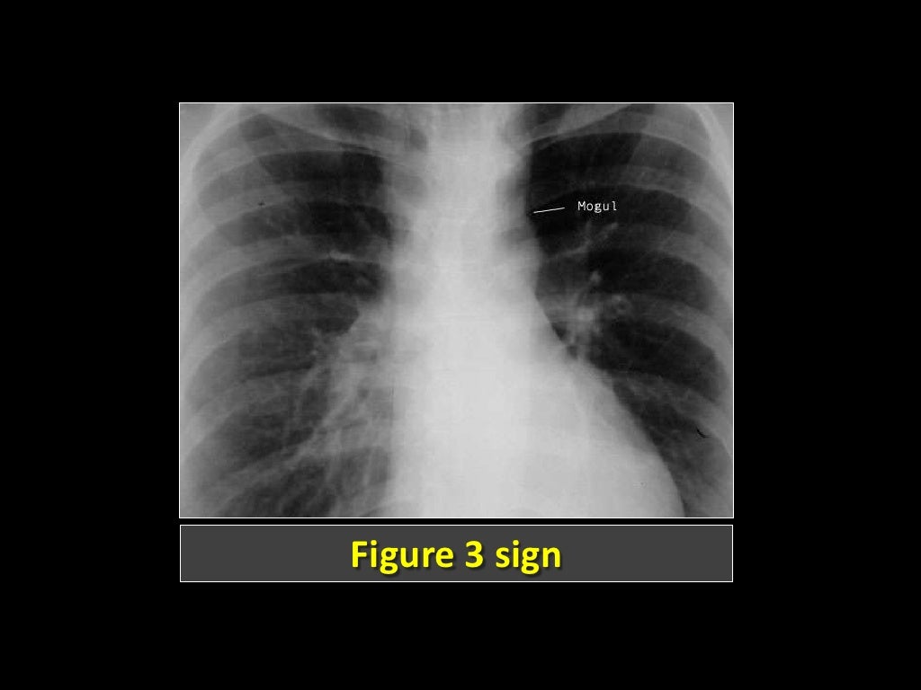 Figure 3 sign fleischner sign-fissure sign-headcheese sign-hilar over…