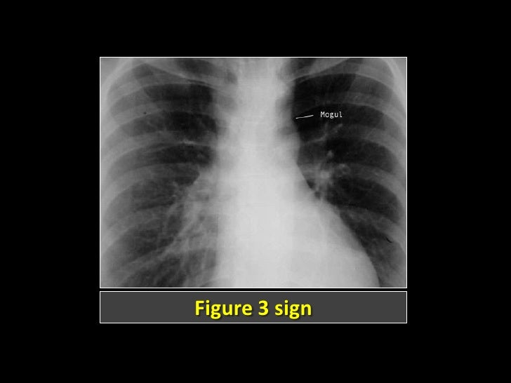 Figure 3 sign fleischner sign-fissure sign-headcheese sign-hilar over…