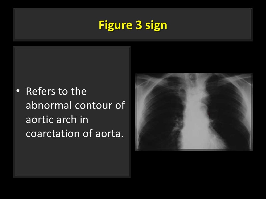Figure 3 sign fleischner sign-fissure sign-headcheese sign-hilar over…