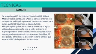 tecnicas de Fijacion escleral sin sutura .pptx