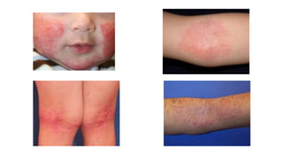 Filaggrin mutation associated disorders | PPTX