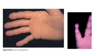 Filaggrin mutation associated disorders | PPTX