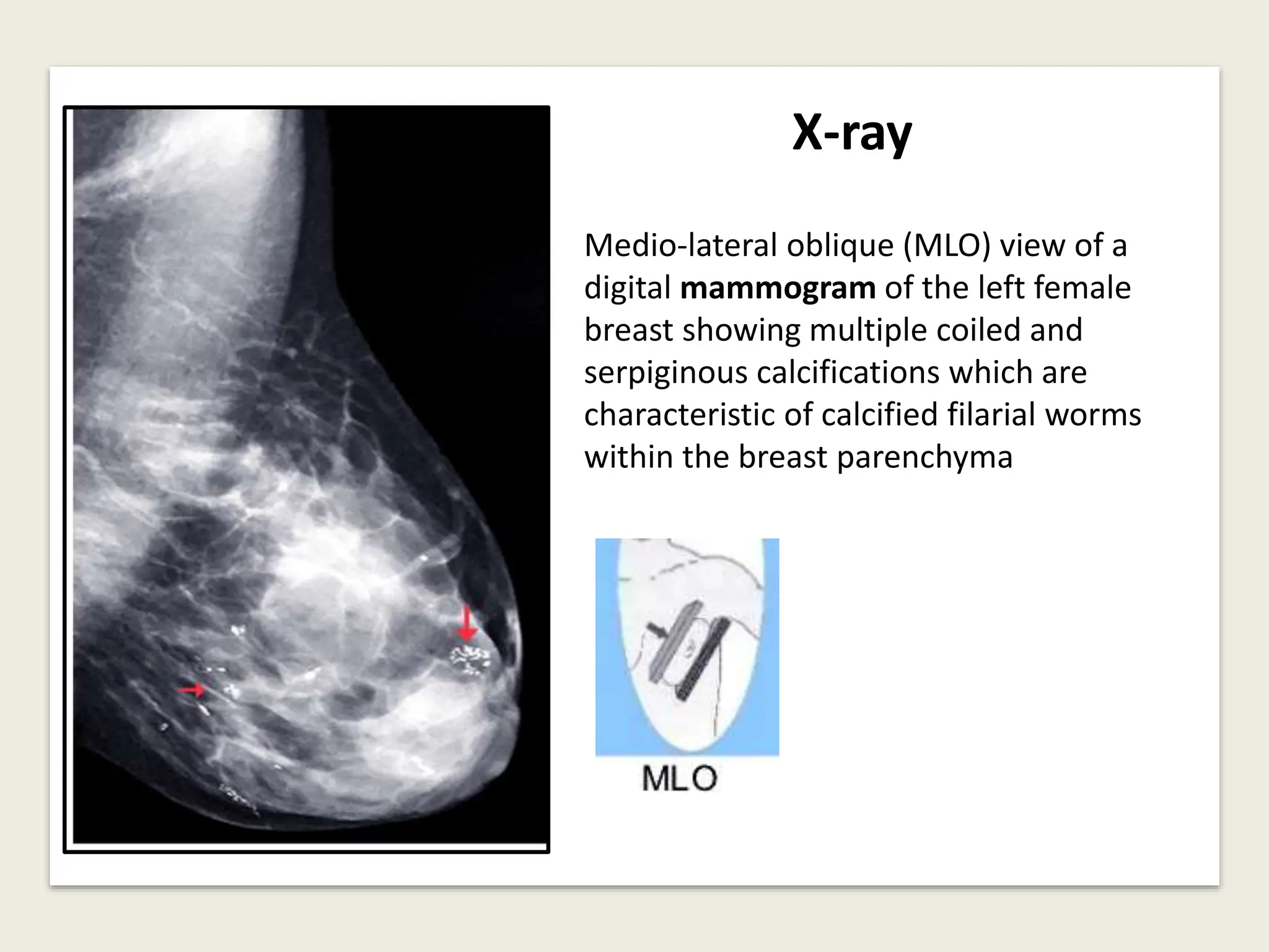 Filariae species & Lymphatic filariasis.pptx