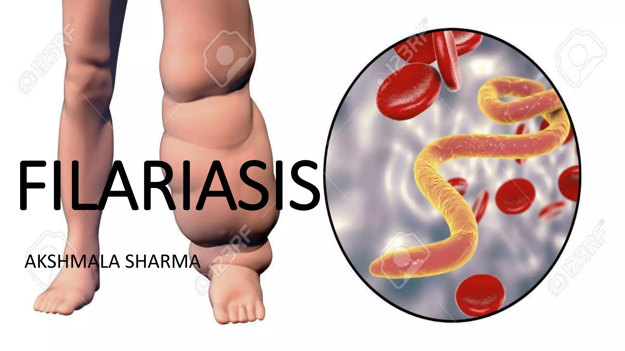 Filariasis | PPT