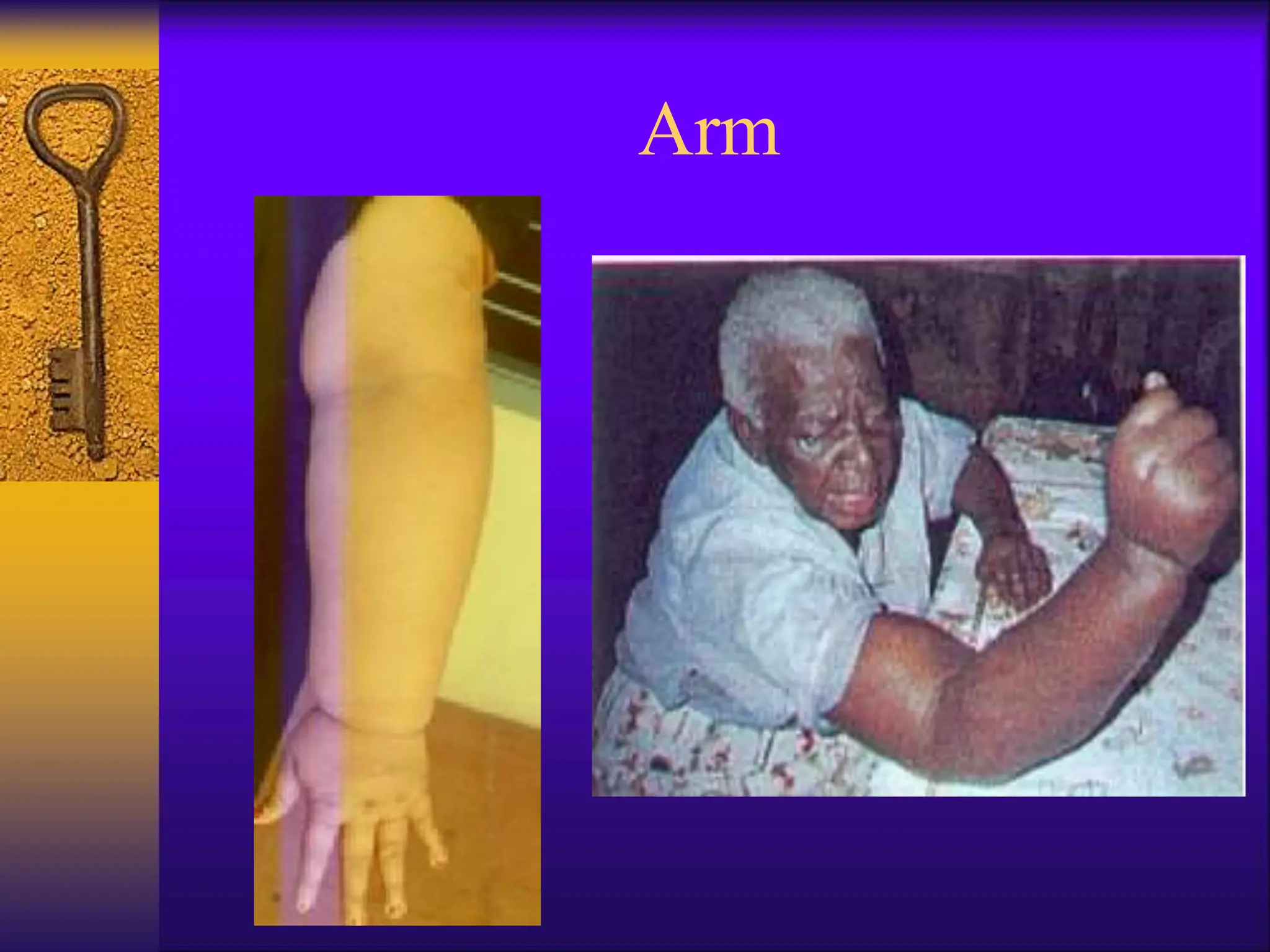 Lecture FIVE -Filariasis Pathogenesis.ppt