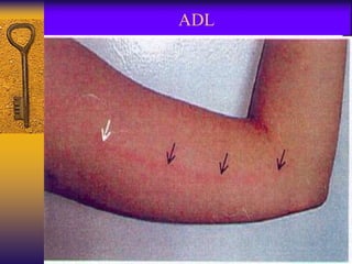 Lecture FIVE -Filariasis Pathogenesis.ppt