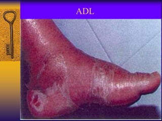 Lecture FIVE -Filariasis Pathogenesis.ppt