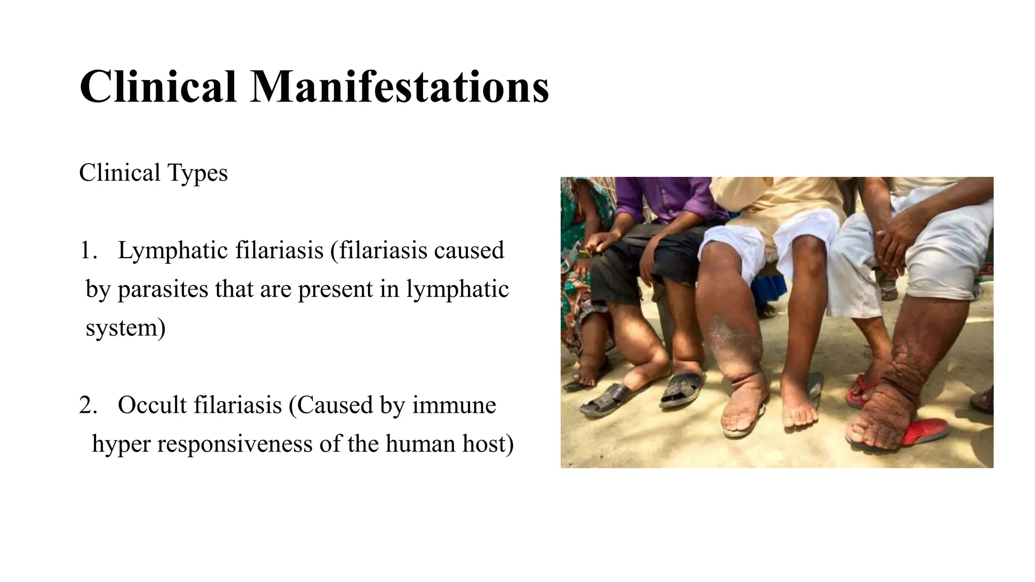 Filariasis I Lymphatic Filariasis I Community Medicine | PPTX