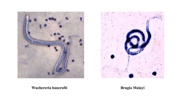 Filariasis I Lymphatic Filariasis I Community Medicine | PPTX ...