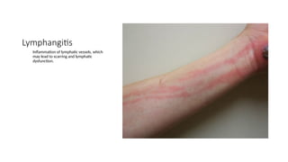 Filariasis is a parasitic disease caused by infection with filarial ...