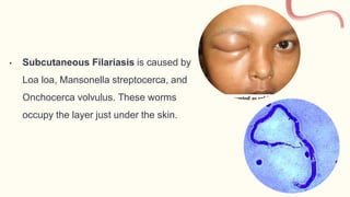 FILARIASIS CASE STUDY NURSING STUDENT.PPTX