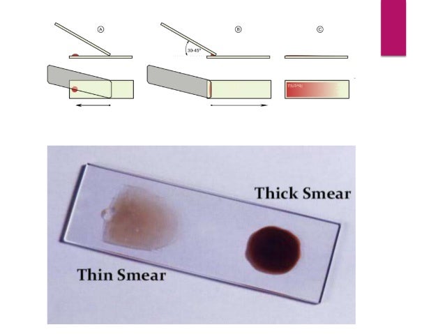 Filariasis laboratory diagnosis