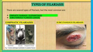 FILARIASIS (TRANSMISSION,TYPES,SYMPTOMS,PREVENTION,MCQS).pptx