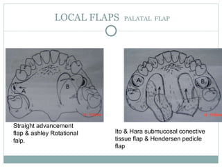 ORO ANTRAL COMMUNICATION(Dr.MANOJ KUMAR) | PPT