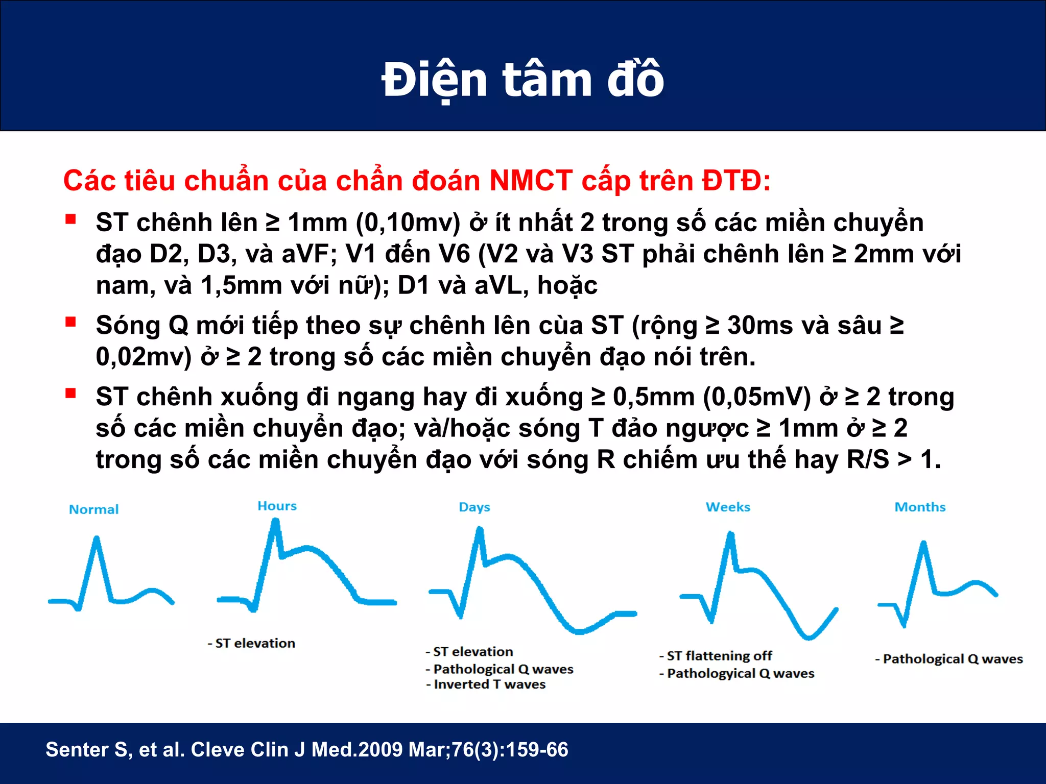 Chẩn đoán và điều trị NMCT | PDF