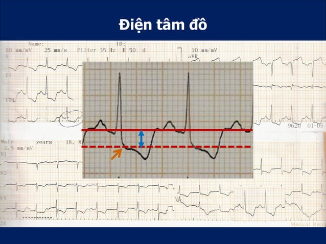 Chẩn đoán và điều trị NMCT | PDF