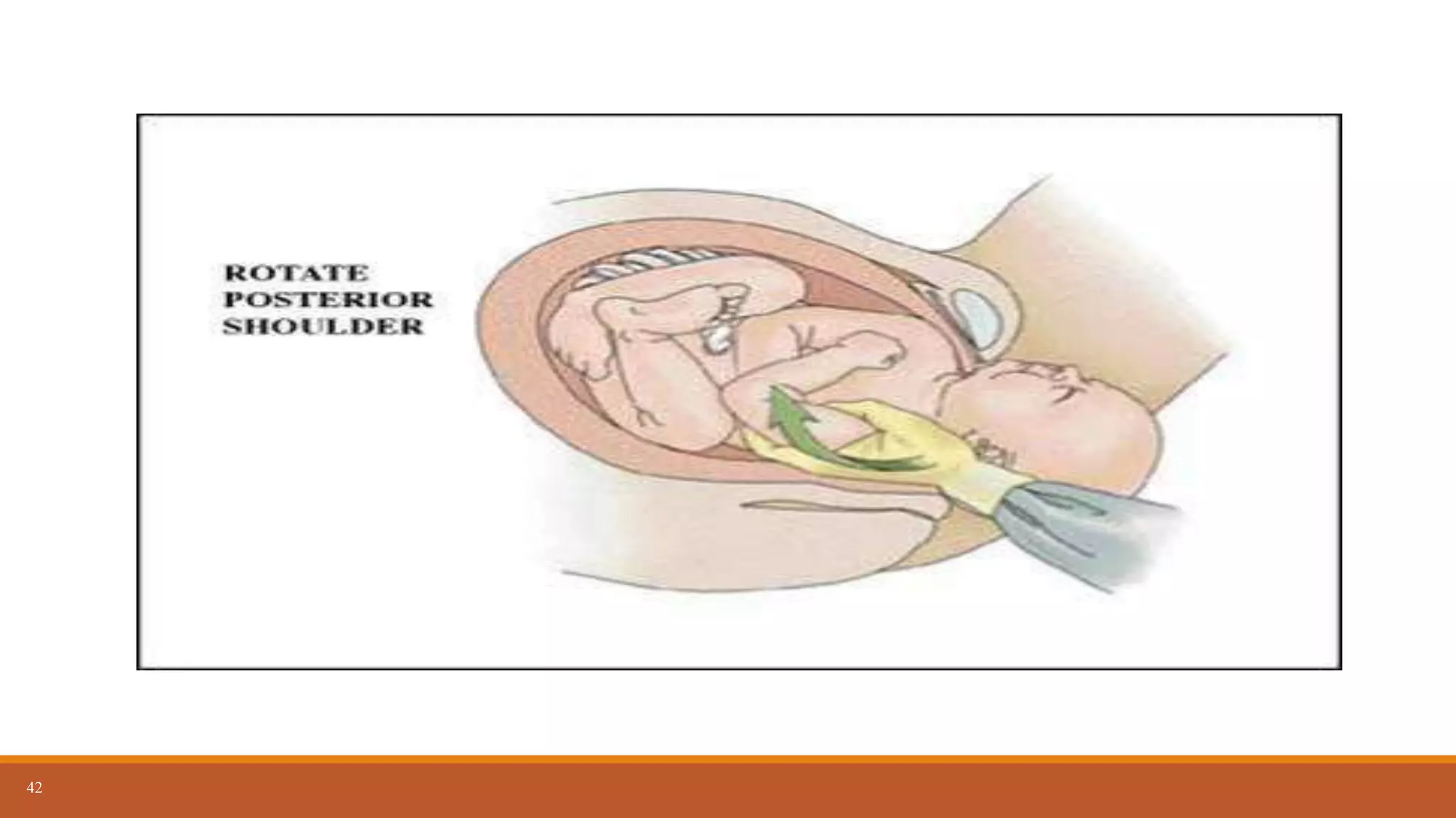 XỬ TRÍ CHUYỂN DẠ BẤT THƯỜNG | PPTX