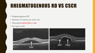 Central Serous Chorioretinopathy- Case Presentation by Toqua Saflo | PPTX