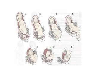 Breech presentation | PDF