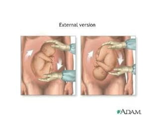 Breech presentation | PDF | Pregnancy | Reproductive Health