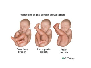 Breech presentation | PDF | Pregnancy | Reproductive Health
