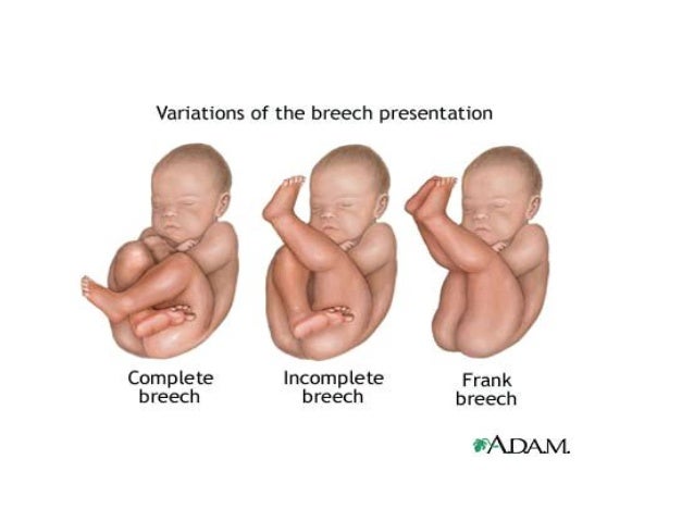 Breech presentation