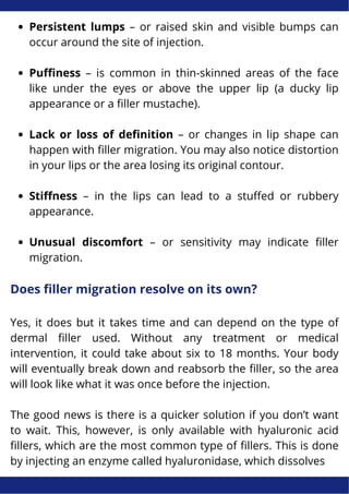 Filler Migration What is it and Why is it Trending.pdf