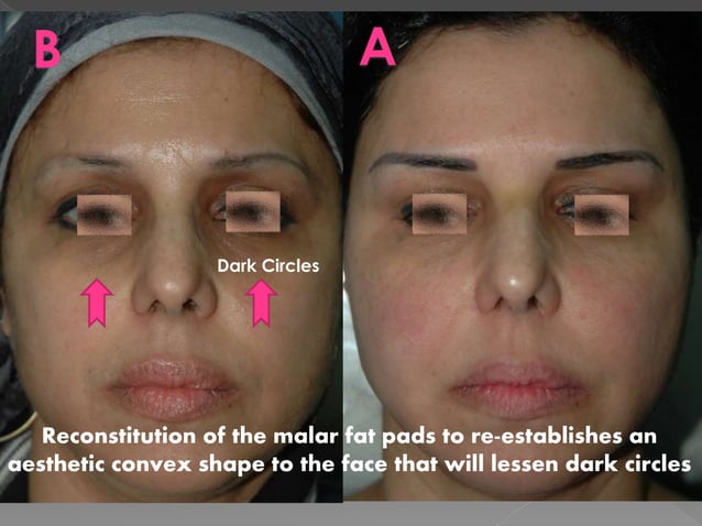 The Art of Liquid Face Lift (Dermal Fillers) | PPT