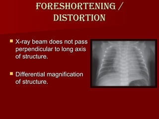 Foreshortened Hand X Ray