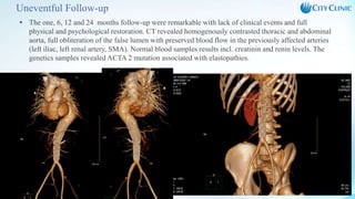 First in man endovascular treatementaodinchildrenbec-2017 [autosaved] | PPT