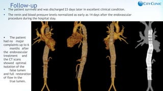 First in man endovascular treatementaodinchildrenbec-2017 [autosaved] | PPT