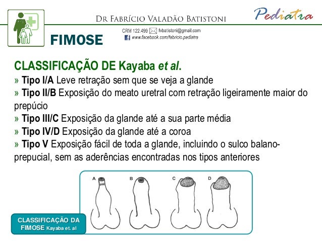 Fimose
