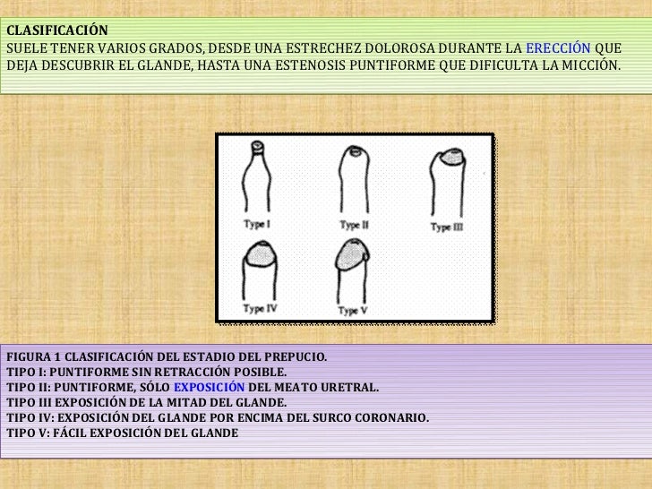 Como Saber Si Tienes Fimosis : Cómo Saber Si Tienes Esta Condición y ...