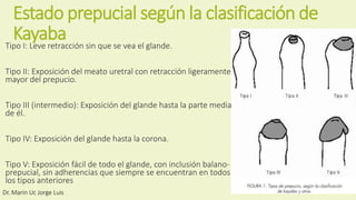 Fimosis y parafimosis | PPTX