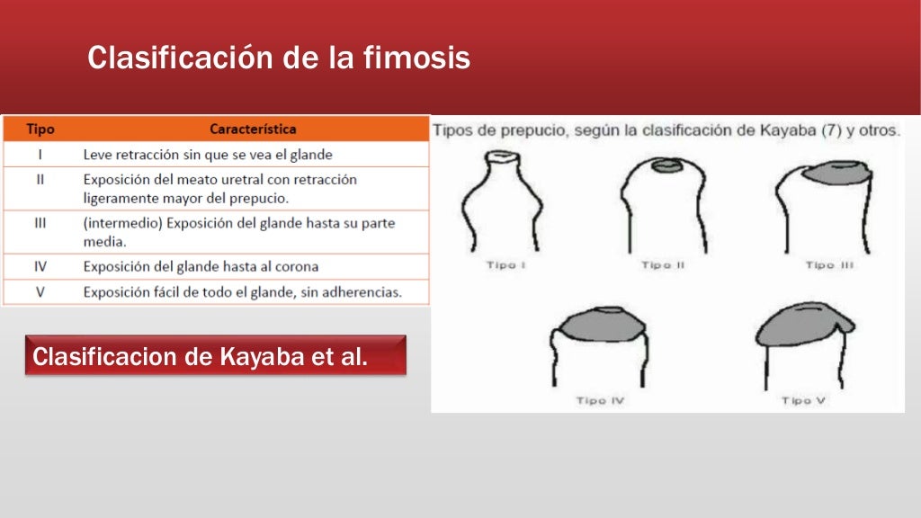 Fimosis en población pediátrica.