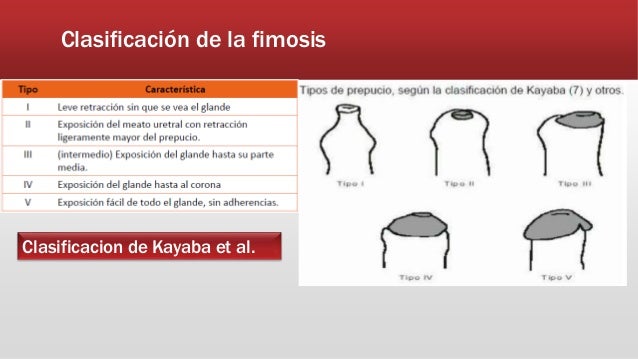 Fimosis En Población Pediátrica